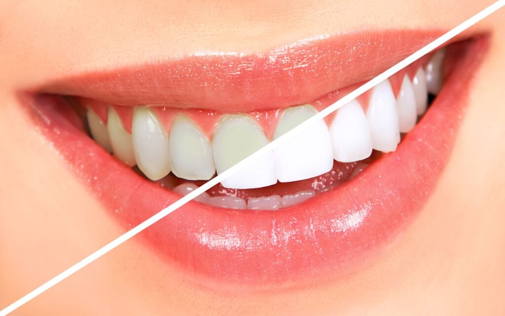 Brighten Your Smile in One Visit: Teeth Whitening at Tatva Dental