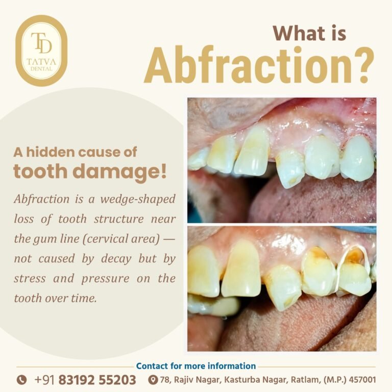 What is Abfraction? Causes, Symptoms & Best Treatment
